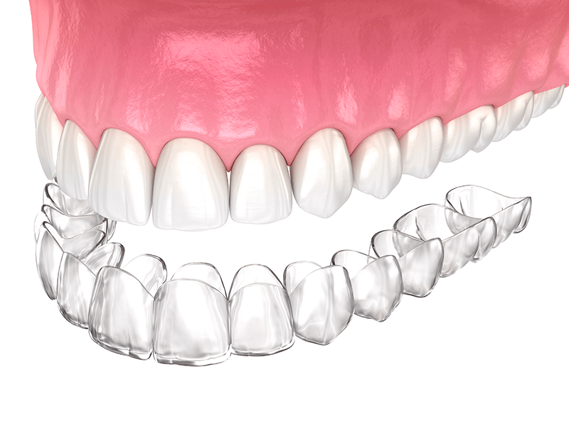 Invisalign em Pinheiros - São Paulo - SP - Nipodonto